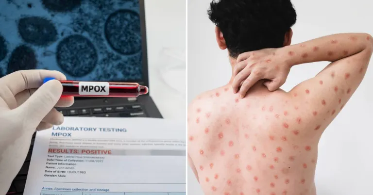 Mpox Philippines Update: New Case and Essential Travel Safety Tips